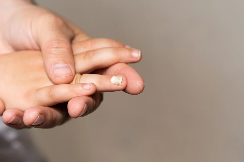 Auriculaire cassé : les symptômes, traitement et précautions